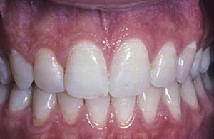Pathologic Tooth Migration and Diastemata - Decisions in Dentistry