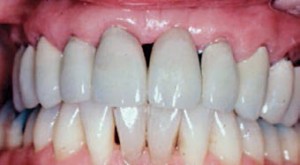 Pathologic Tooth Migration and Diastemata - Decisions in Dentistry
