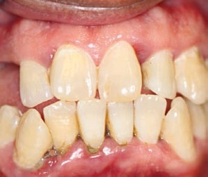 Pathologic Tooth Migration and Diastemata - Decisions in Dentistry