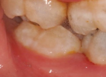 Treating Tipped and Ectopically Positioned Molars