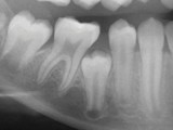 Treating Tipped and Ectopically Positioned Molars