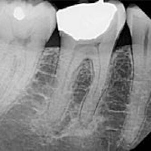 Universal Classification in Endodontic Diagnosis - Decisions in Dentistry