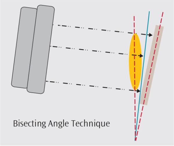 Considerations for Pediatric Dental Radiography - Decisions in Dentistry