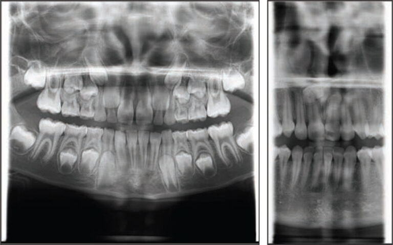 Considerations for Pediatric Dental Radiography - Decisions in Dentistry