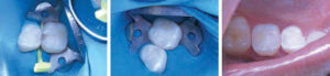 Restorative Dentistry in the Primary Dentition - Decisions in Dentistry