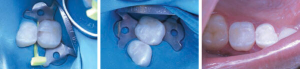 Restorative Dentistry in the Primary Dentition - Decisions in Dentistry