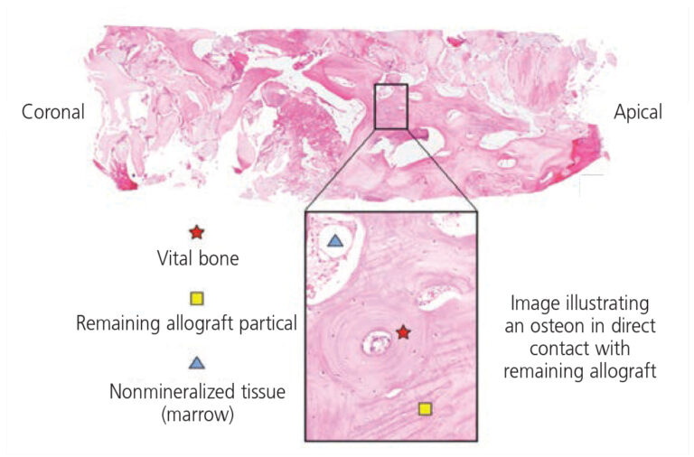 Socket Augmentation Using Polytetrafluoroethylene Membranes - Decisions ...
