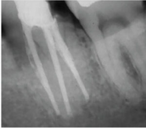 Shaping, Disinfecting and Obturating Root Canals - Decisions in Dentistry