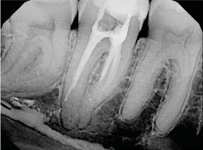 Shaping, Disinfecting and Obturating Root Canals - Decisions in Dentistry