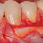 root-coverage-fig1e - Decisions in Dentistry
