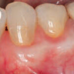 root-coverage-features - Decisions in Dentistry