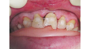 Treating Dental Trauma - Decisions in Dentistry