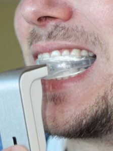 Accelerated Orthodontic Tooth Movement - Decisions in Dentistry