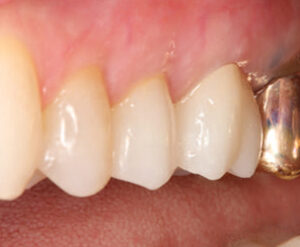 Selection Guidelines for All-Ceramic Restorations - Decisions in Dentistry