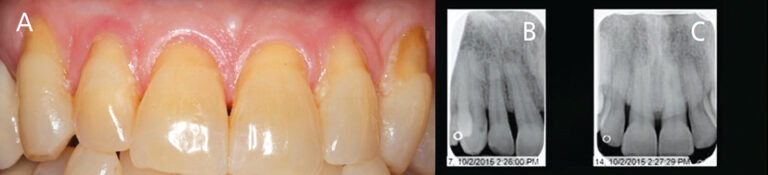Diagnosis and Treatment of Gingival Recession - Decisions in Dentistry