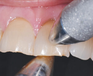 Examining for Periodontal Disease - Decisions in Dentistry