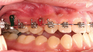 Clinical Uses for Temporary Anchorage Devices - Decisions in Dentistry