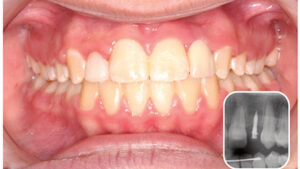 Clinical Uses for Temporary Anchorage Devices - Decisions in Dentistry