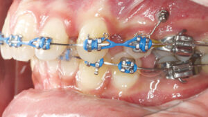 Clinical Uses for Temporary Anchorage Devices - Decisions in Dentistry