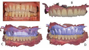 Digital Workflow for Implant Dentistry - Decisions in Dentistry