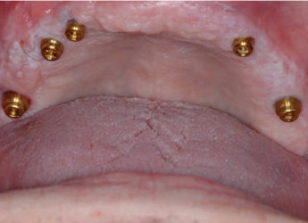 The Case for Implant-Retained, Tissue-Supported Overdentures ...