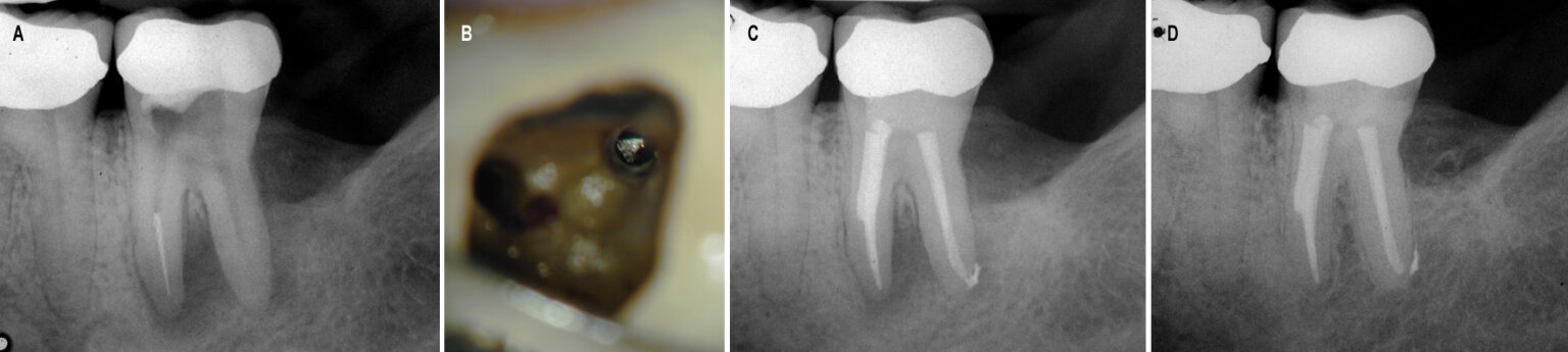 Approaches to Nonsurgical Root Canal Retreatment