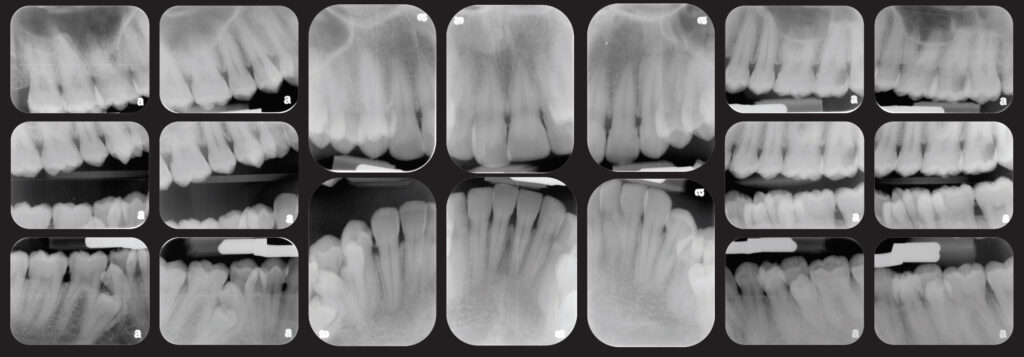 Bilateral Multiple Hyperdontia With Nonsyndromic Association