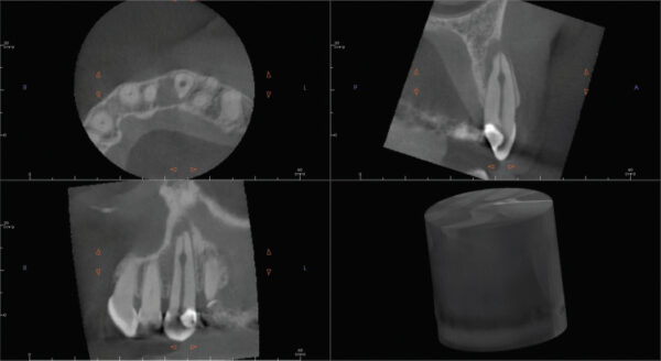 Accurate Diagnosis in Endodontic Therapy