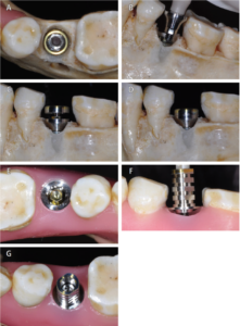 Understanding Implant Abutment Connection Interfaces
