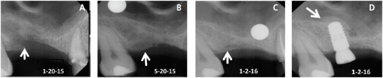Alveolar Bone and Implant Therapy