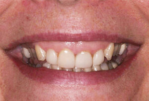 Decision Making in Managing Excess Gingival Display