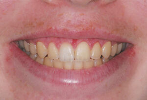 Decision Making in Managing Excess Gingival Display