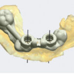 surgical-guides-fig-8 - Decisions in Dentistry