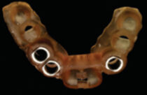 Surgical Guide Techniques for Dental Implant Placement