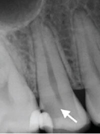 Paradigm Shift in Vital Pulp Therapy - Decisions in Dentistry