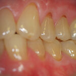 carious-lesions-fig-2 - Decisions in Dentistry