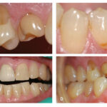carious-lesions-fig-2 - Decisions in Dentistry
