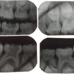 fig-1-molar-incisor - Decisions in Dentistry