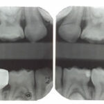 fig-1-molar-incisor - Decisions in Dentistry