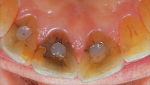 Diagnosis and Prognosis for Dark Tooth Bleaching - Decisions in Dentistry