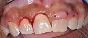 A Gingivectomy Procedure Using a Diode Laser - Decisions in Dentistry