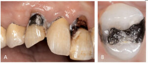 Biofilm Formation and Contact Angles on Dental Restorative Biomaterials