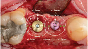 Treatment Planning Strategies For Dental Implant Procedures