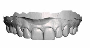 Digital Workflow for Porcelain Veneers - Decisions in Dentistry