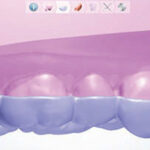 occlusal-guard-fig-1 - Decisions in Dentistry