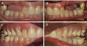 Alternative Esthetic Clasp For Removable Partial Dentures on Maxillary ...