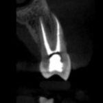 Endo figure 2F - Decisions in Dentistry