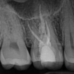 Endo figure 1 F - Decisions in Dentistry