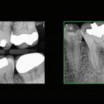 Endo figure 1 F - Decisions in Dentistry