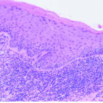 gingivitis fig 3 - Decisions in Dentistry